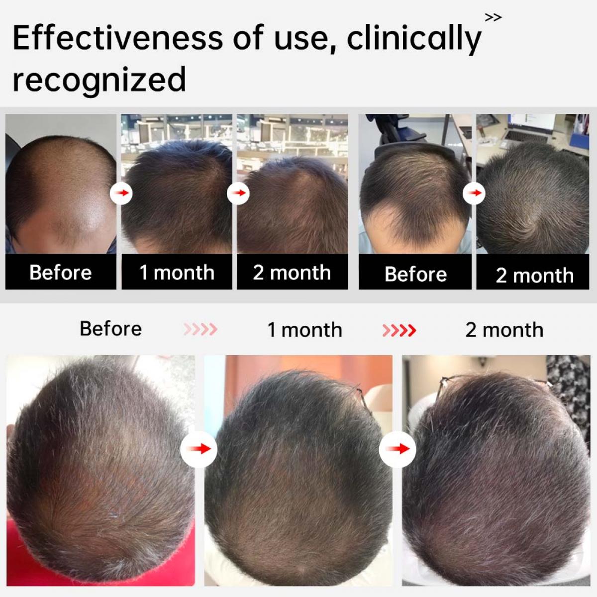 FREYARA 96 LLLT Laser Therapy Cap,Highly Focused Energy, Directly ...