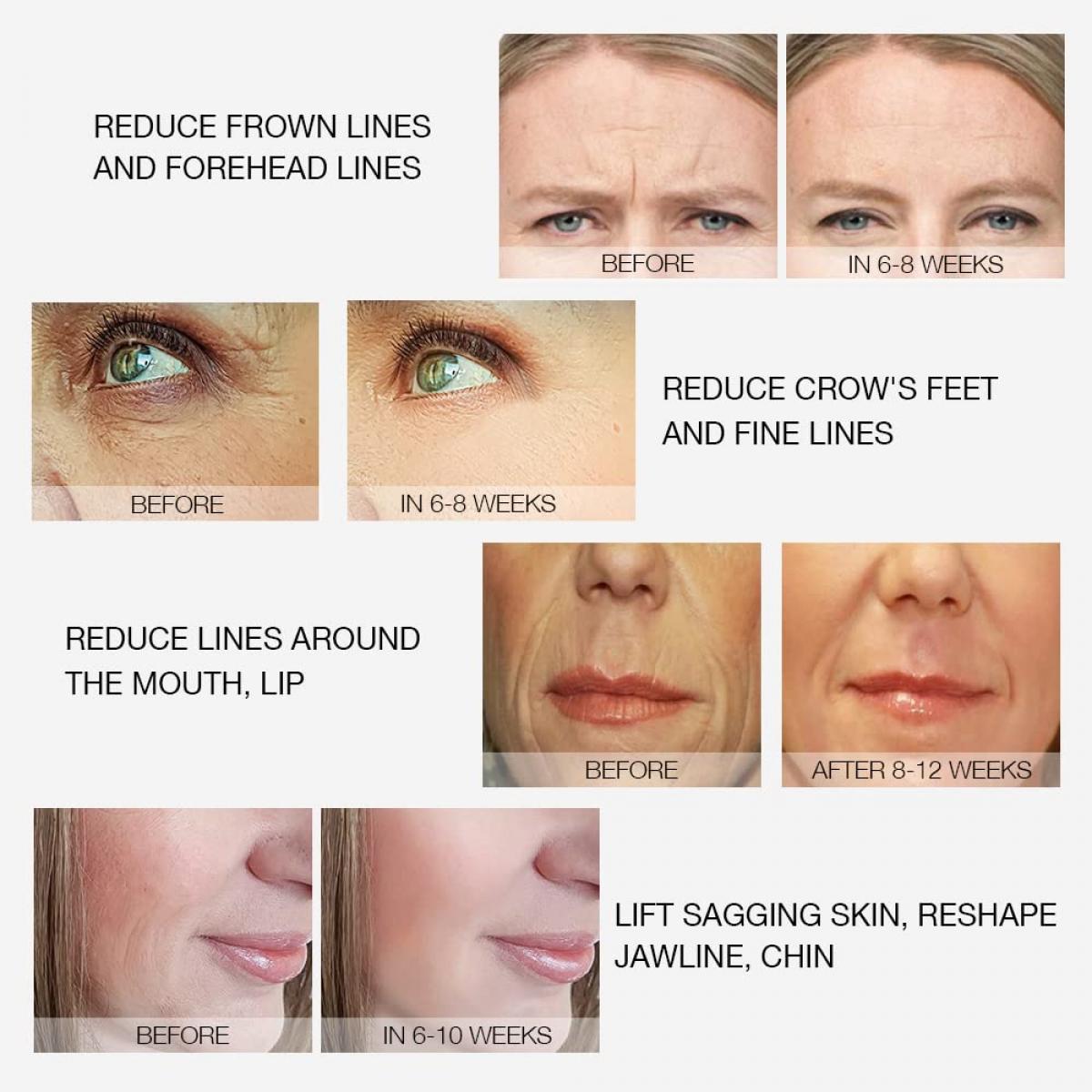 FREYARA MLAY Professional RF Beauty Machine for Lifting, Toning ...