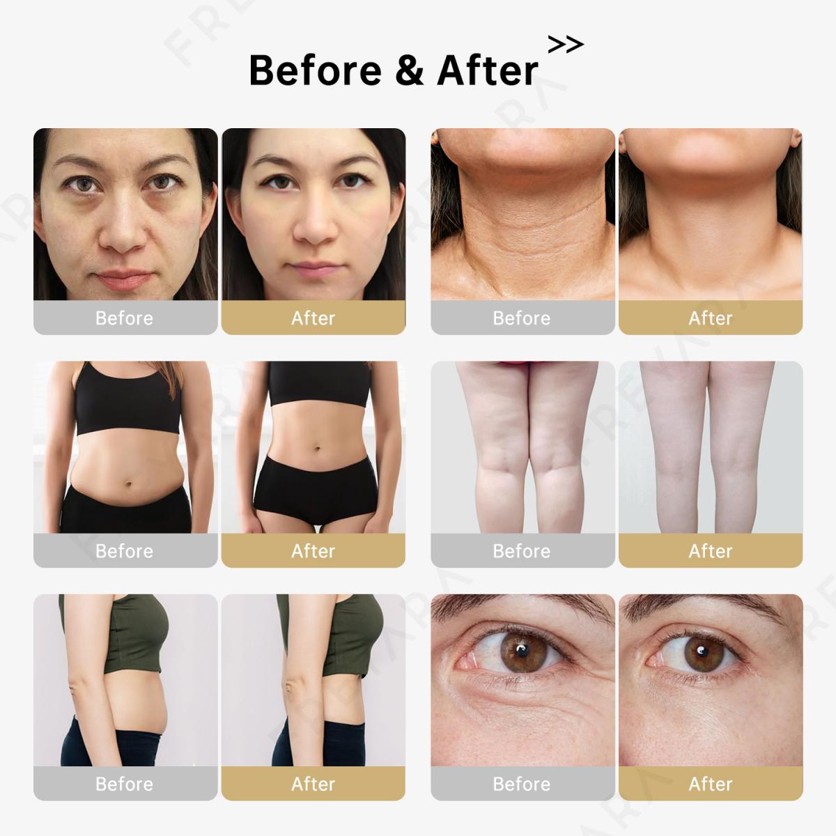 FREYARA 3in1 40K RF Cavitation Machine, Body Sculpting Slimming Device ...